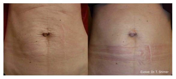 Evolve-Tite (1 session) - Non Surgical Skin Tightening in Bakersfield ...